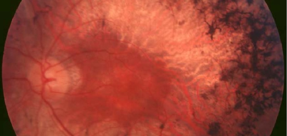 Investigadores del ‘National Eye Institute’ identifican una nueva ...